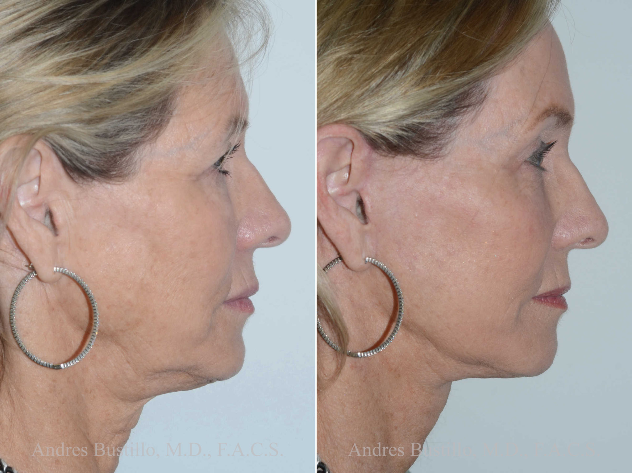 Lifting de cejas Miami, FL | Lifting de frente | Andres Bustillo, MD, FACS